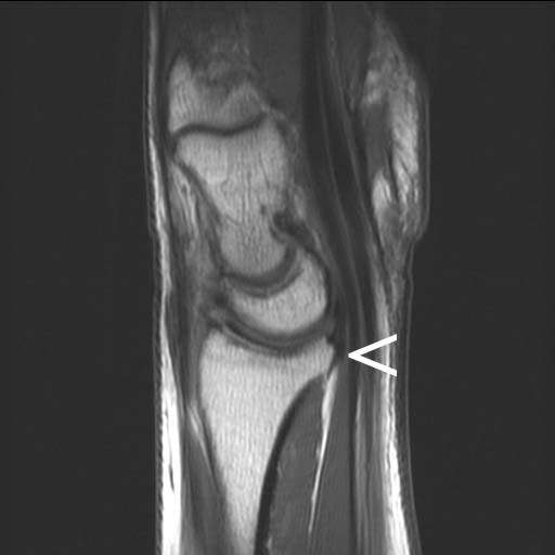 Anatomy Of The Distal Radius